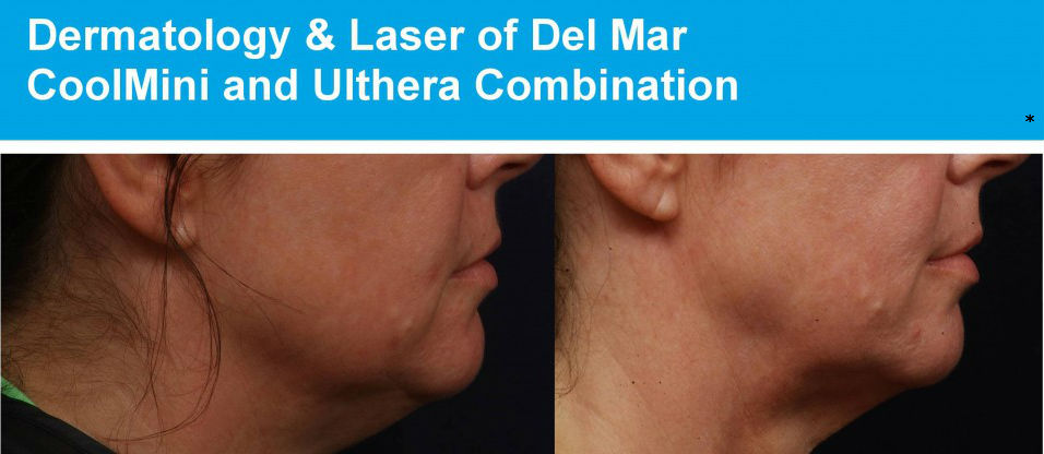 Cool Mini Double Chin Reduction Del Mar San Diego CA