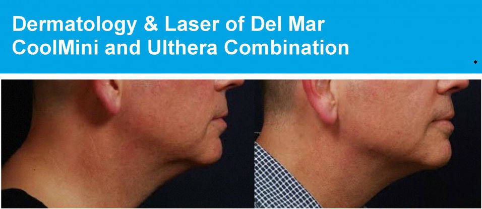 Cool Mini Double Chin Reduction Del Mar San Diego CA