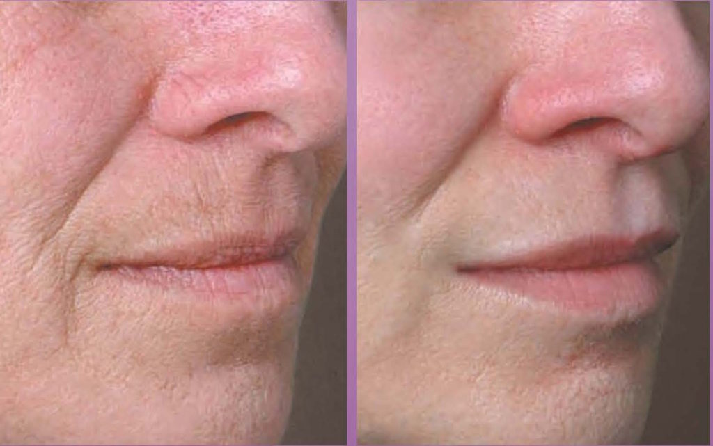 Introducing Volbella