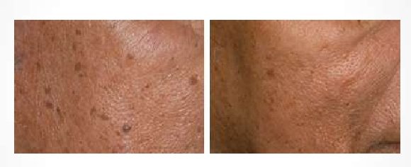 Introducing the NEW Alex TriVantage Laser