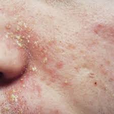 Causes and treatments for red skin