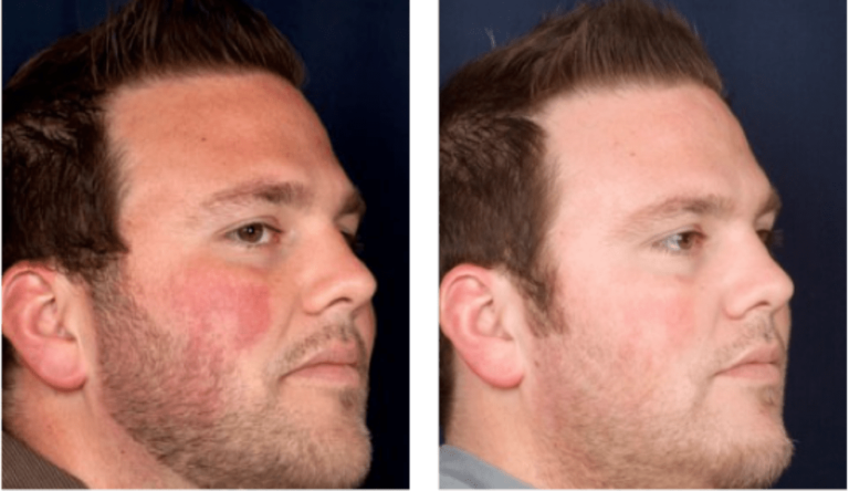 VBeam Perfecta Laser Skin Treatment San Diego Del Mar CA