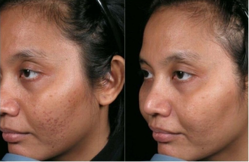 Intracel RF Microneedling at Dermatology & Laser of Del Mar