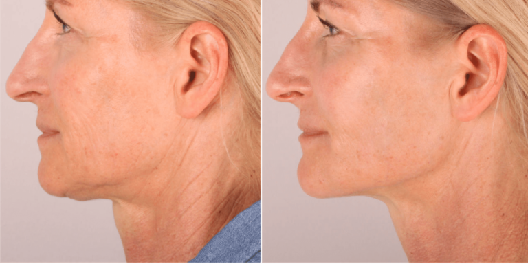 Hyperdilute Radiesse